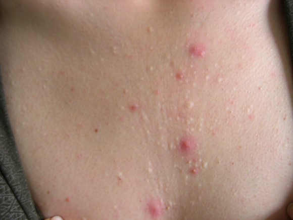 Red Spot On Skin No Itch Funny Quotes About Raising Money Red Bumps On Chest And Back Baby red-spot-on-skin-no-itch-funny-quotes-about-raising-money-red-bumps-on-chest-and-back-baby